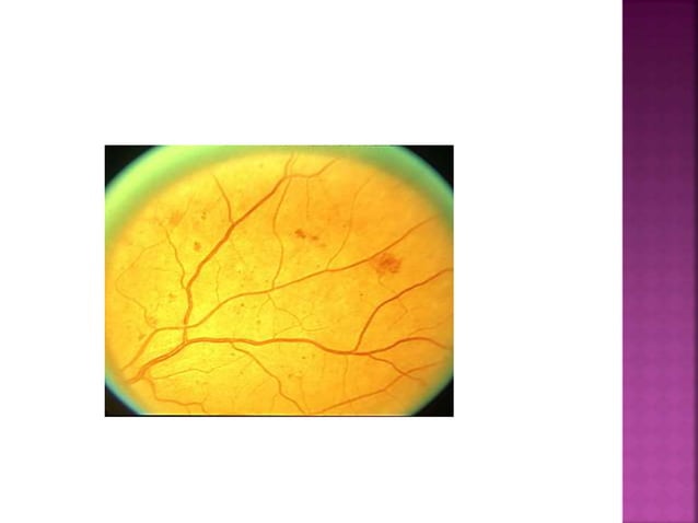 Diabetic retinopathy.pptx on diabetic changes in Retina | PPT