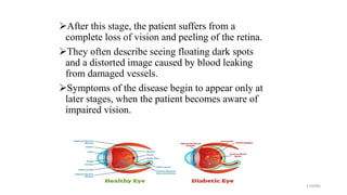 diabetic Retinopathy. Eye detection of disease | PPTX