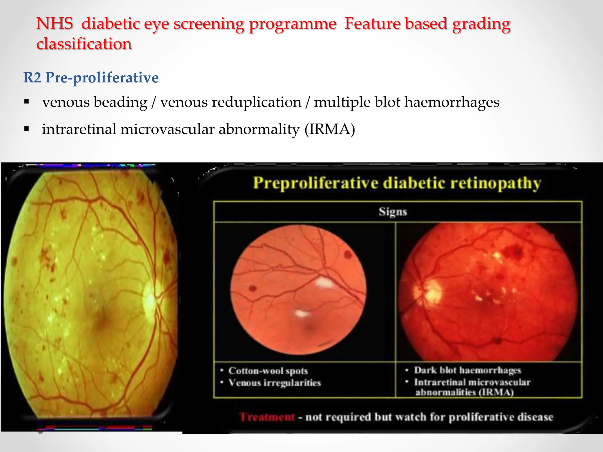 DIABETIC RETINOPATHY.pptx ophthalmological | PPT