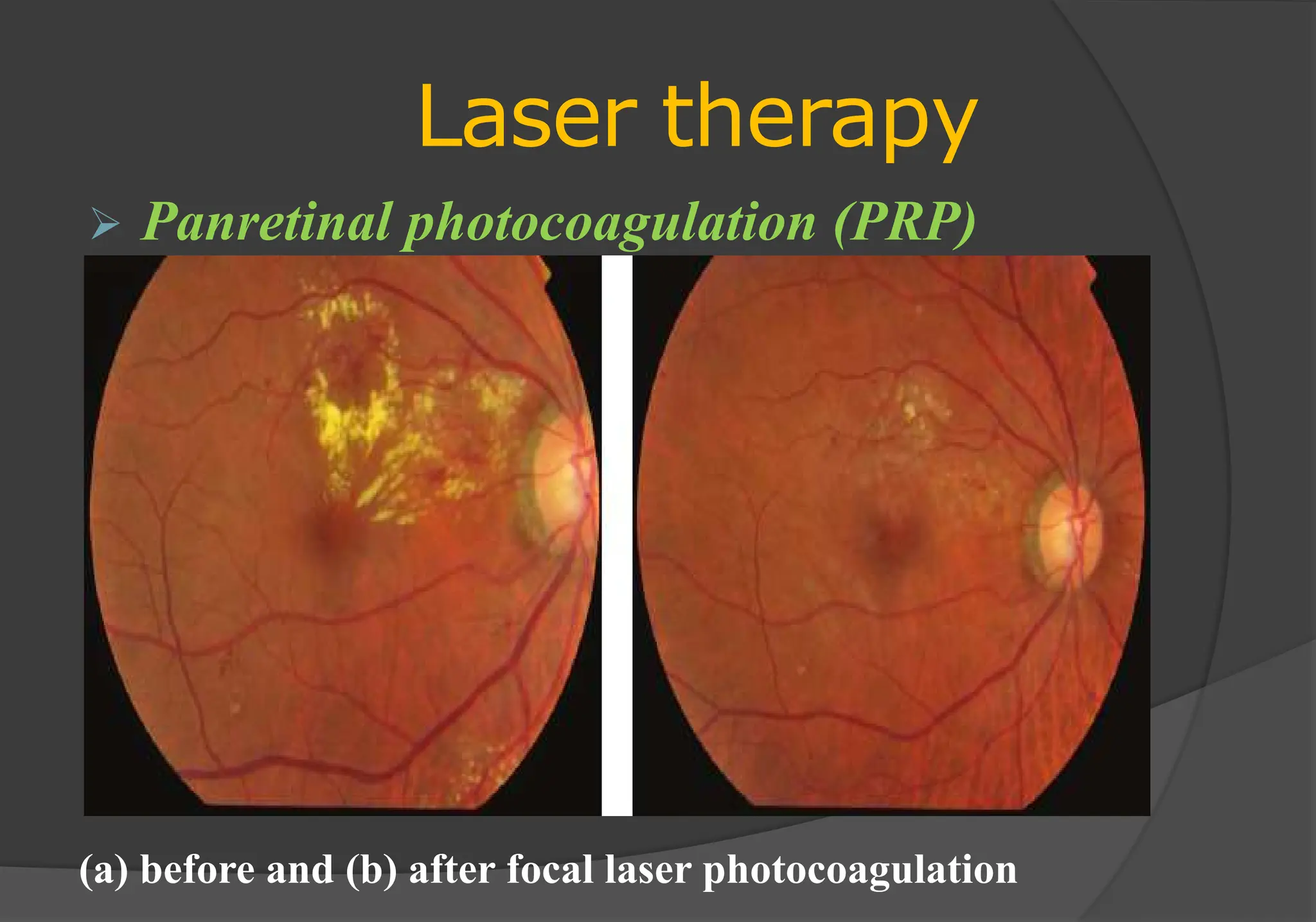 Diabetic Retinopathy.pdf internal medicine | PDF