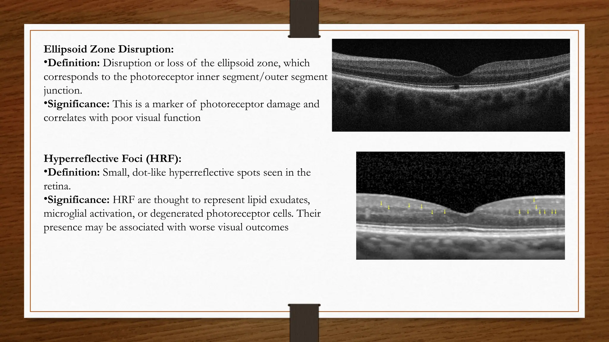 DIABETIC RETINOPATHY Ophthalmology PGjr1 | PPTX