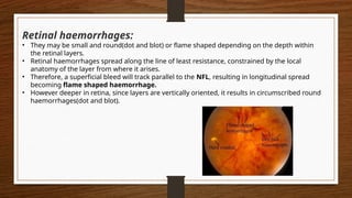 DIABETIC RETINOPATHY Ophthalmology PGjr1 | PPTX