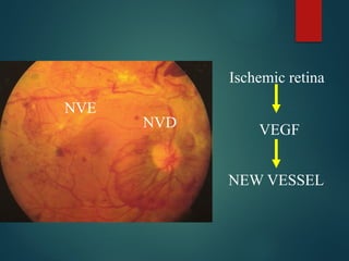 Diabetic Retinopathy - epidemiology, pathogenesis and clinical features ...