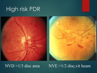 Diabetic Retinopathy - epidemiology, pathogenesis and clinical features ...