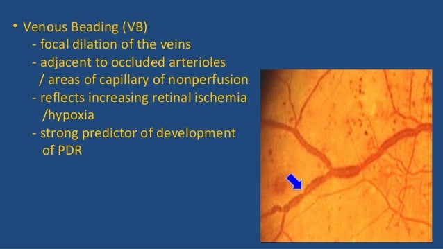 Diabetic Retinopathy