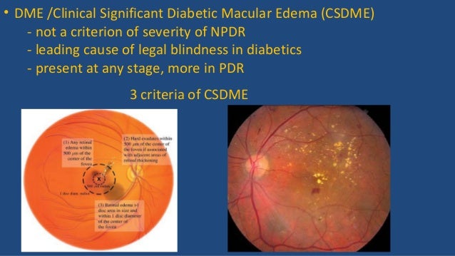 Diabetic Retinopathy