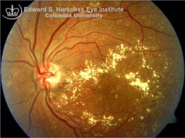 Diabetic retinopathy 30-3-2011