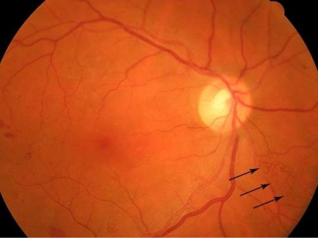 Diabetic retinopathy 30-3-2011