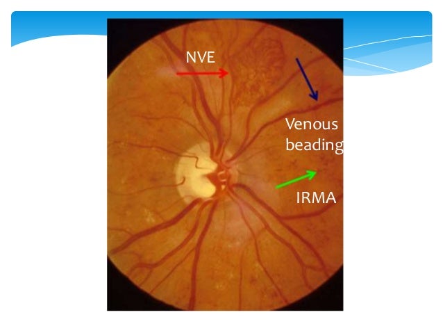 Diabetic retinopathy 30-3-2011