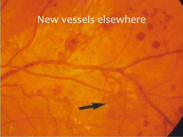 Diabetic retinopathy 30-3-2011