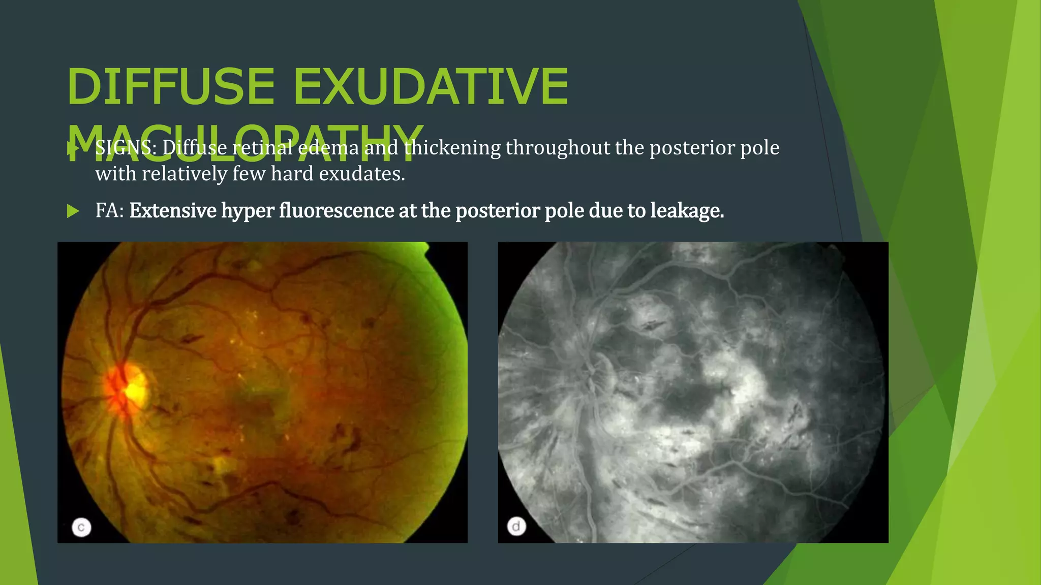 Diabetic Retinopathy- PDR and CSME | PPTX