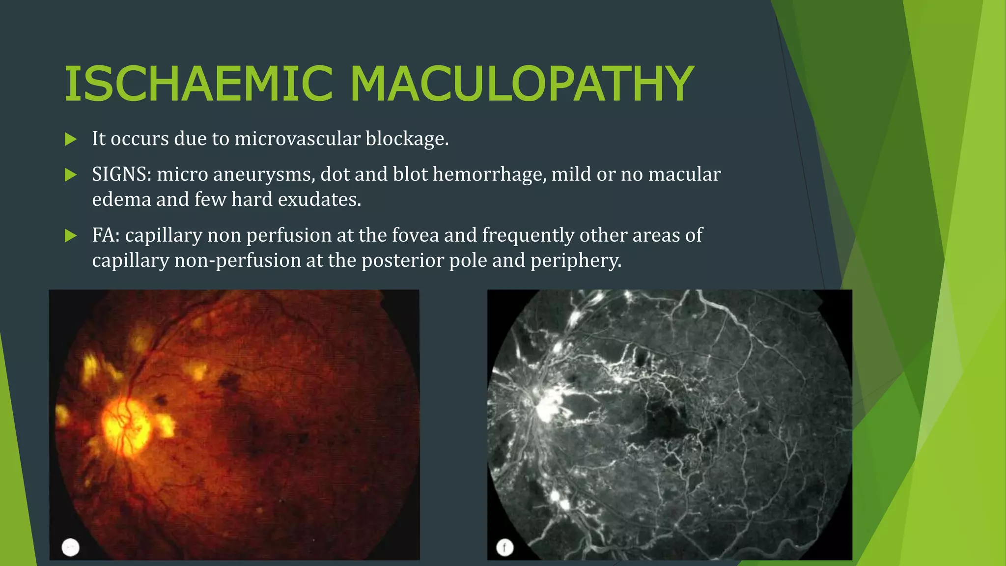 Diabetic Retinopathy- PDR and CSME | PPTX
