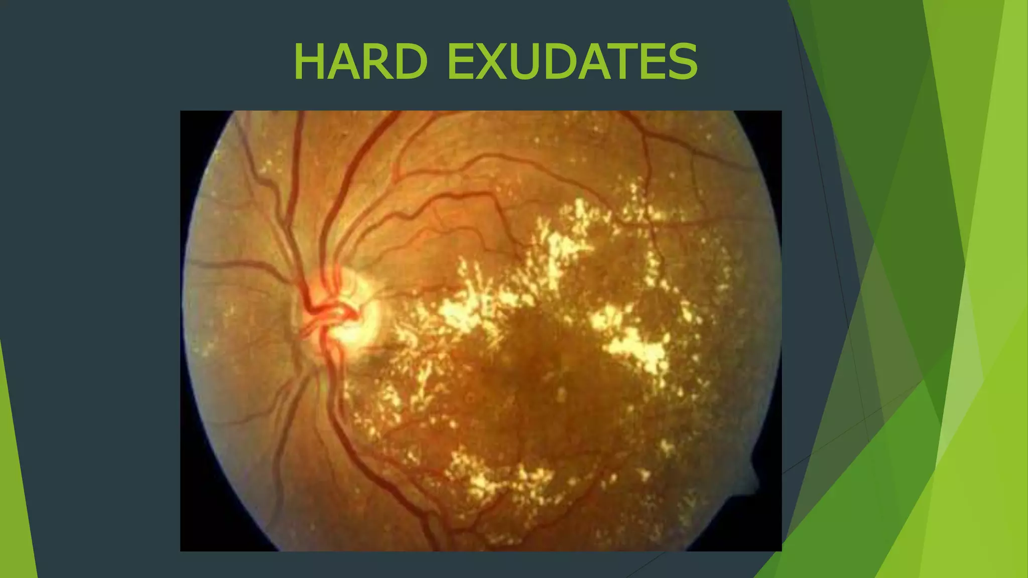 Diabetic Retinopathy- PDR and CSME | PPTX