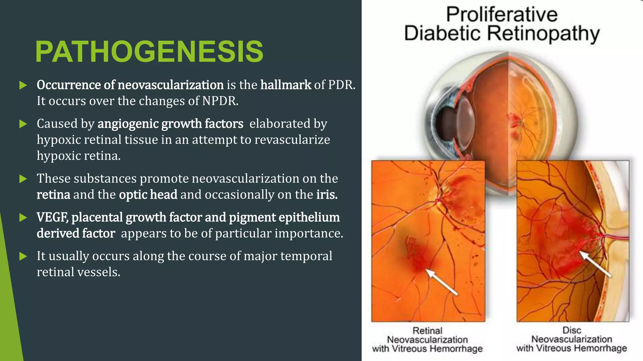 Diabetic Retinopathy- PDR and CSME | PPTX