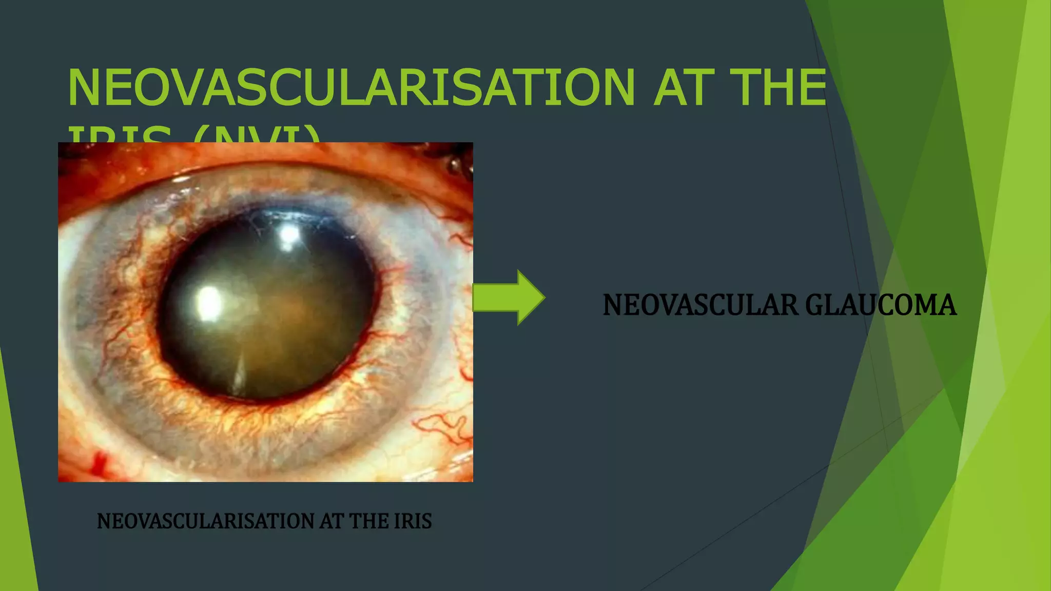 Diabetic Retinopathy- PDR and CSME | PPTX