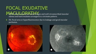 Diabetic Retinopathy- PDR and CSME | PPTX
