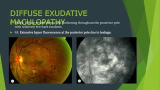 Diabetic Retinopathy- PDR and CSME | PPTX