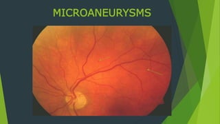 Diabetic Retinopathy- PDR and CSME | PPTX