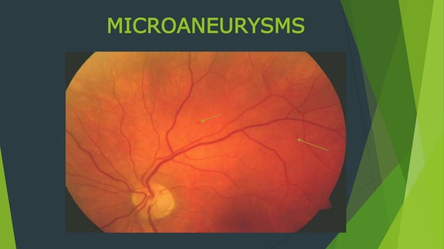 Diabetic Retinopathy- PDR and CSME | PPTX