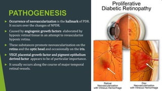 Diabetic Retinopathy- PDR and CSME | PPTX