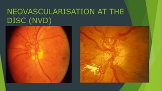 Diabetic Retinopathy- PDR and CSME | PPTX