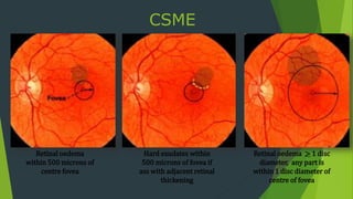 Diabetic Retinopathy- PDR and CSME | PPT