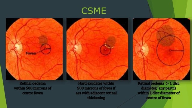 Diabetic Retinopathy- PDR and CSME