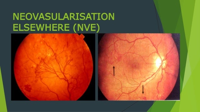 Diabetic Retinopathy- PDR and CSME