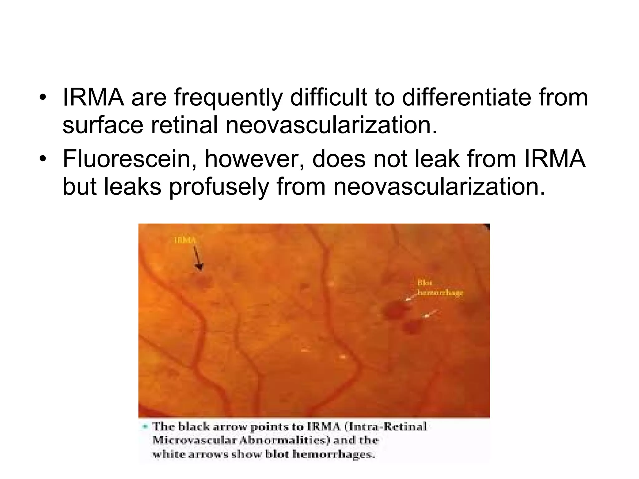 Diabetic retinopathy pathophysiology | PPT