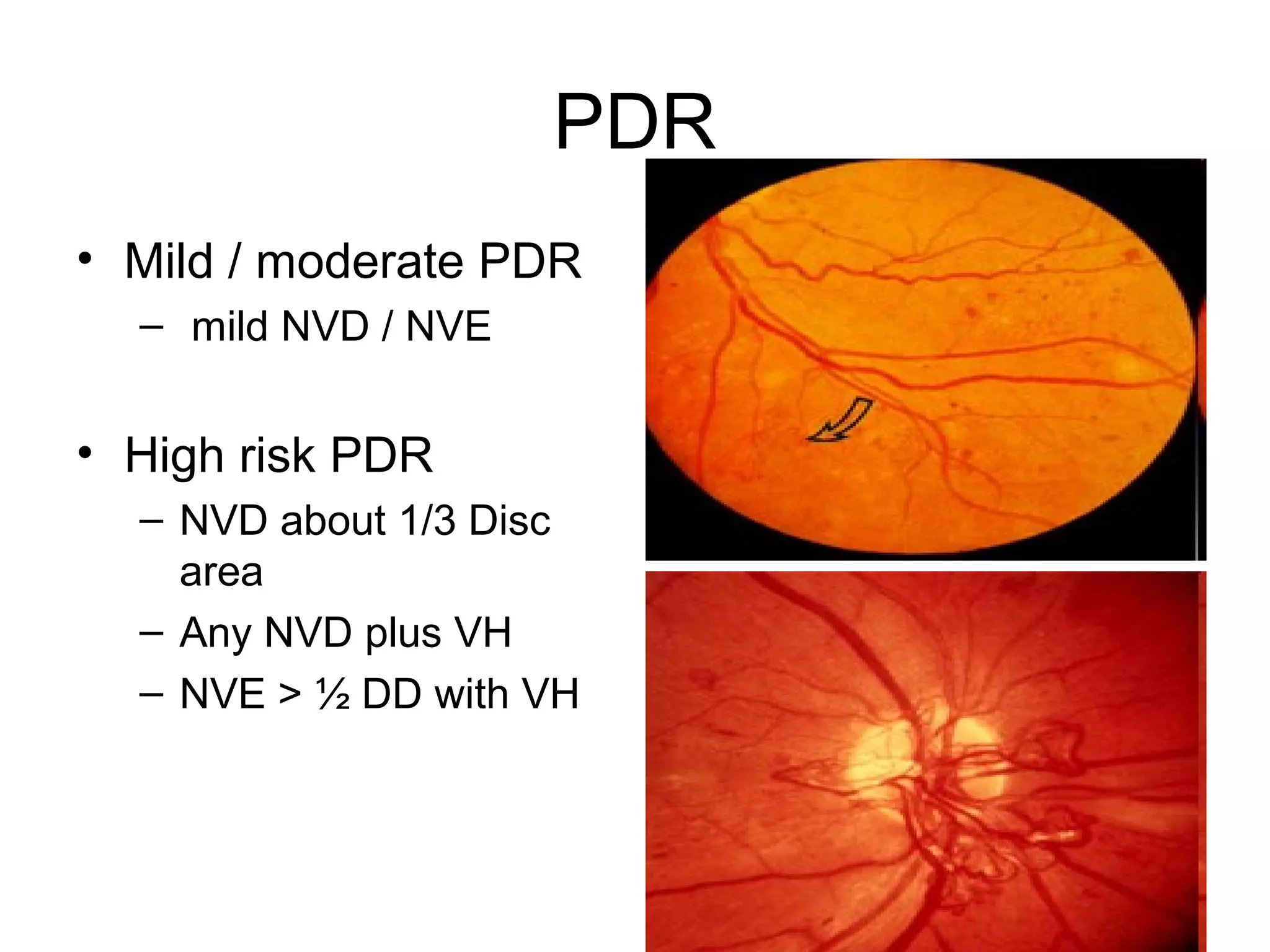 Diabetic retinopathy pathophysiology | PPT