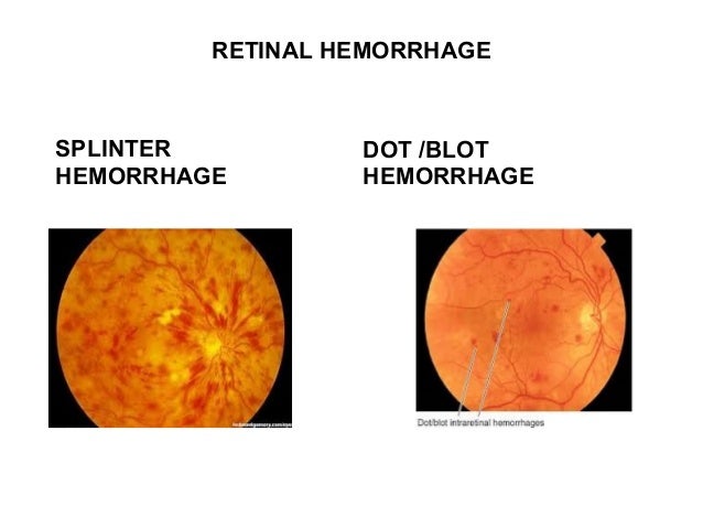 Splinter Hemorrhages Eye