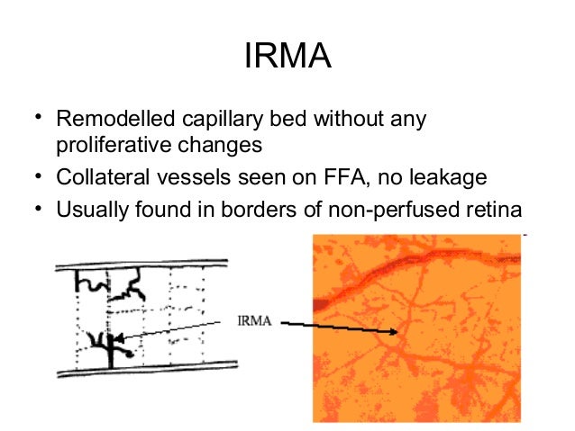 Diabetic retinopathy pathophysiology