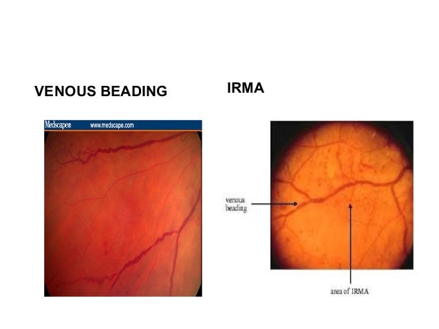Diabetic retinopathy pathophysiology
