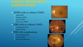 Diabetic Retinopathy Basics.pptx