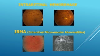 Diabetic Retinopathy Basics.pptx