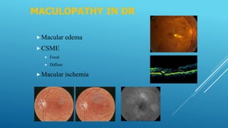 Diabetic Retinopathy Basics.pptx