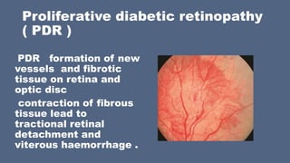 DIABETIC RETINOPATHY DEMYSTIFIED | PPTX | Eye and Vision Conditions ...