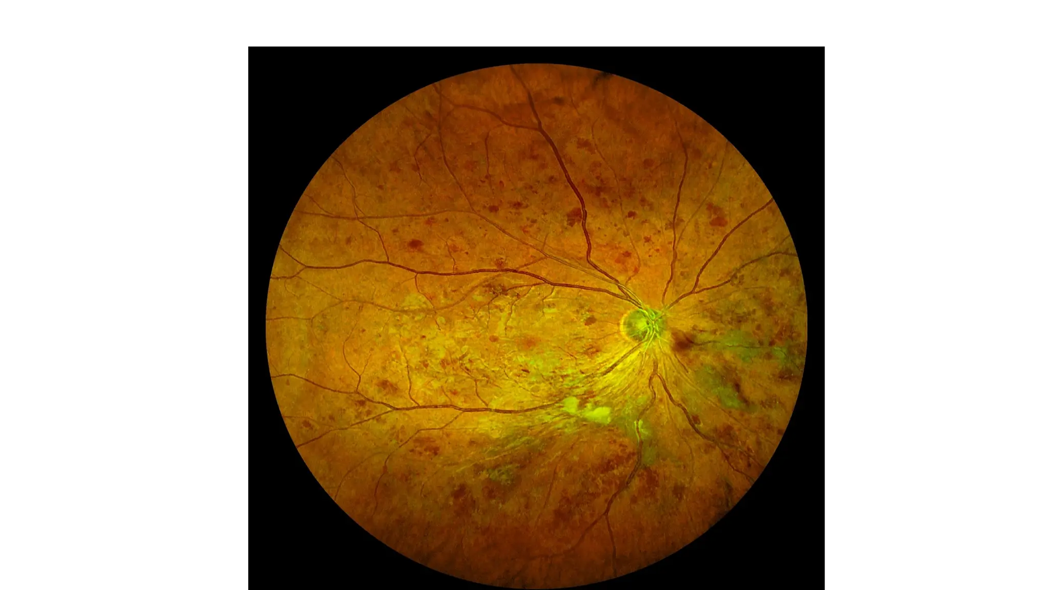 Diabetic Retinopathy & Diabetic Macula Edema.pptx