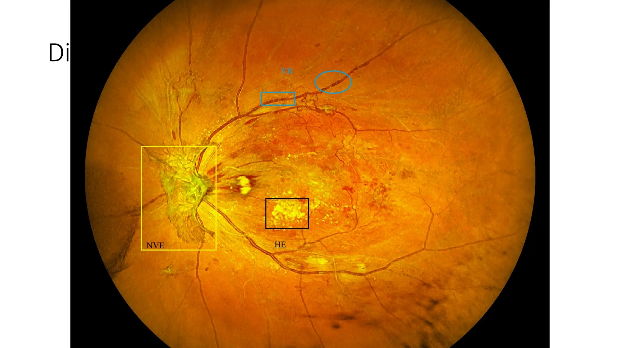 Diabetic Retinopathy & Diabetic Macula Edema.pptx