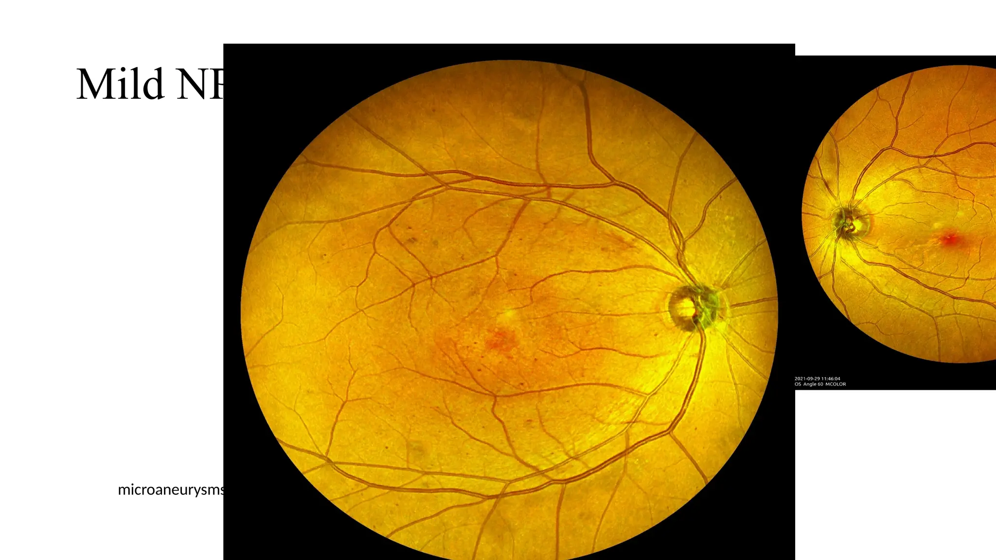 Diabetic Retinopathy & Diabetic Macula Edema.pptx
