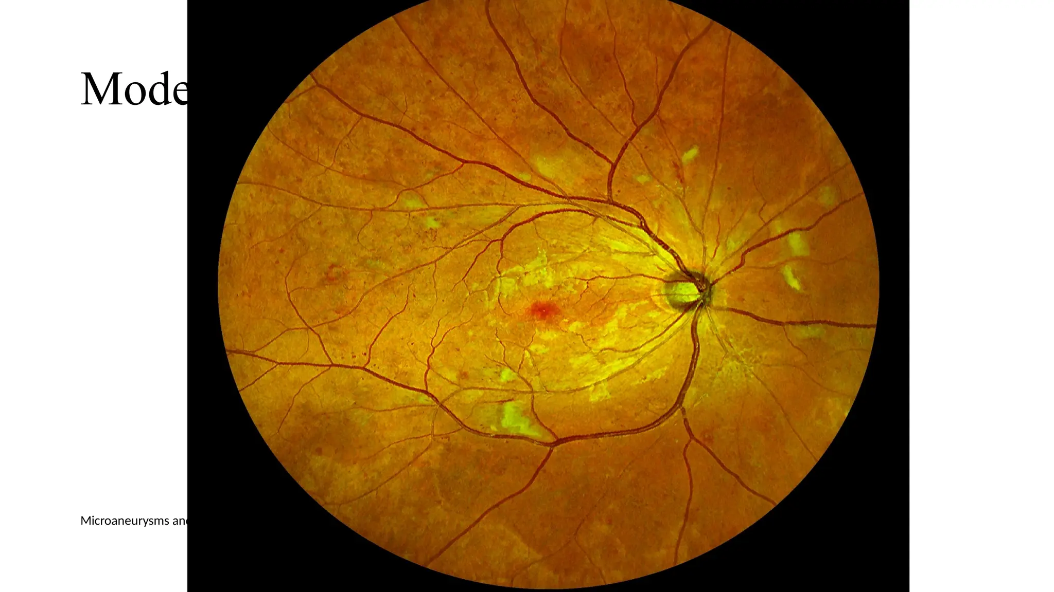 Diabetic Retinopathy & Diabetic Macula Edema.pptx