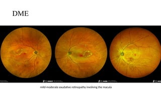 Diabetic Retinopathy & Diabetic Macula Edema.pptx