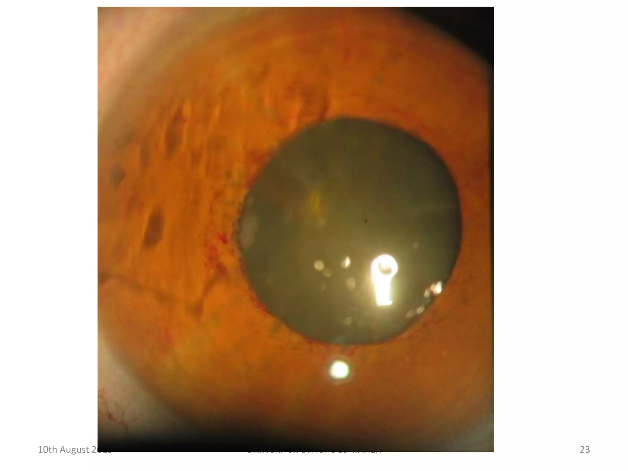 DR VIVEK WANI TALK ON DIABETIC RETINOPATHY FOR KLE MBBS STUDENTS UG ...