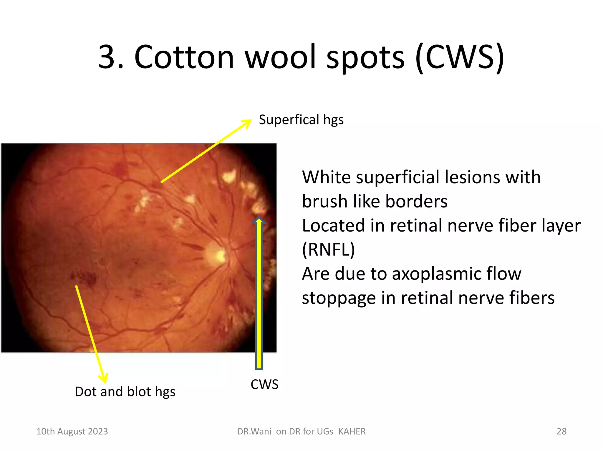 DR VIVEK WANI TALK ON DIABETIC RETINOPATHY FOR KLE MBBS STUDENTS UG ...