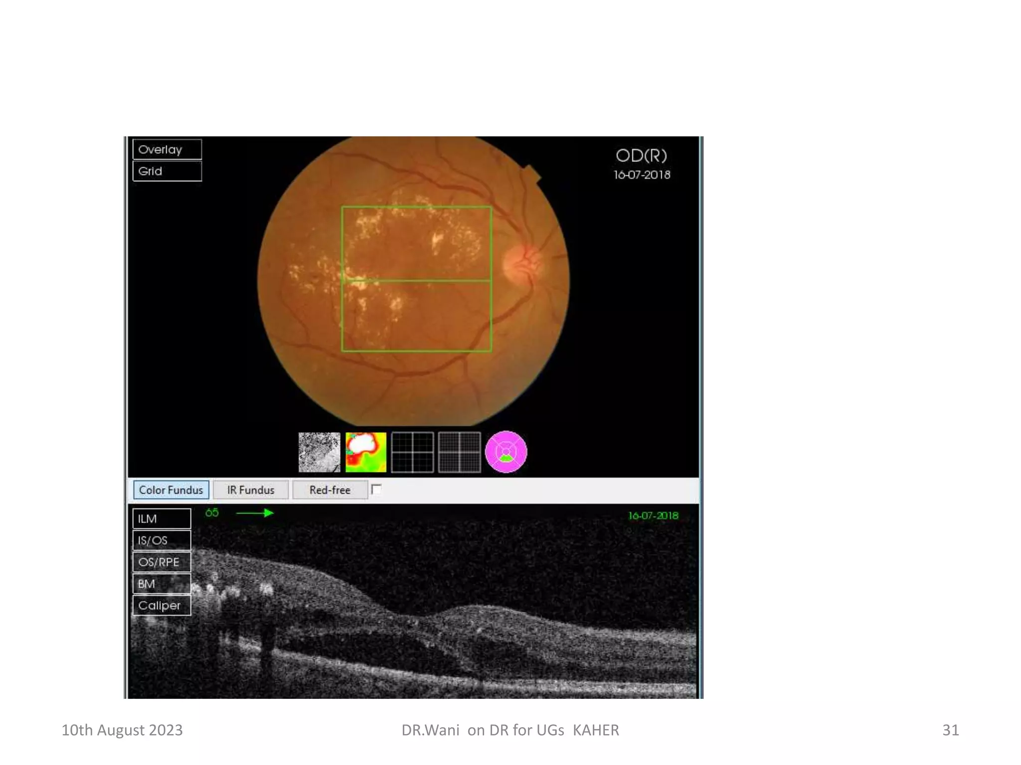 DR VIVEK WANI TALK ON DIABETIC RETINOPATHY FOR KLE MBBS STUDENTS UG ...