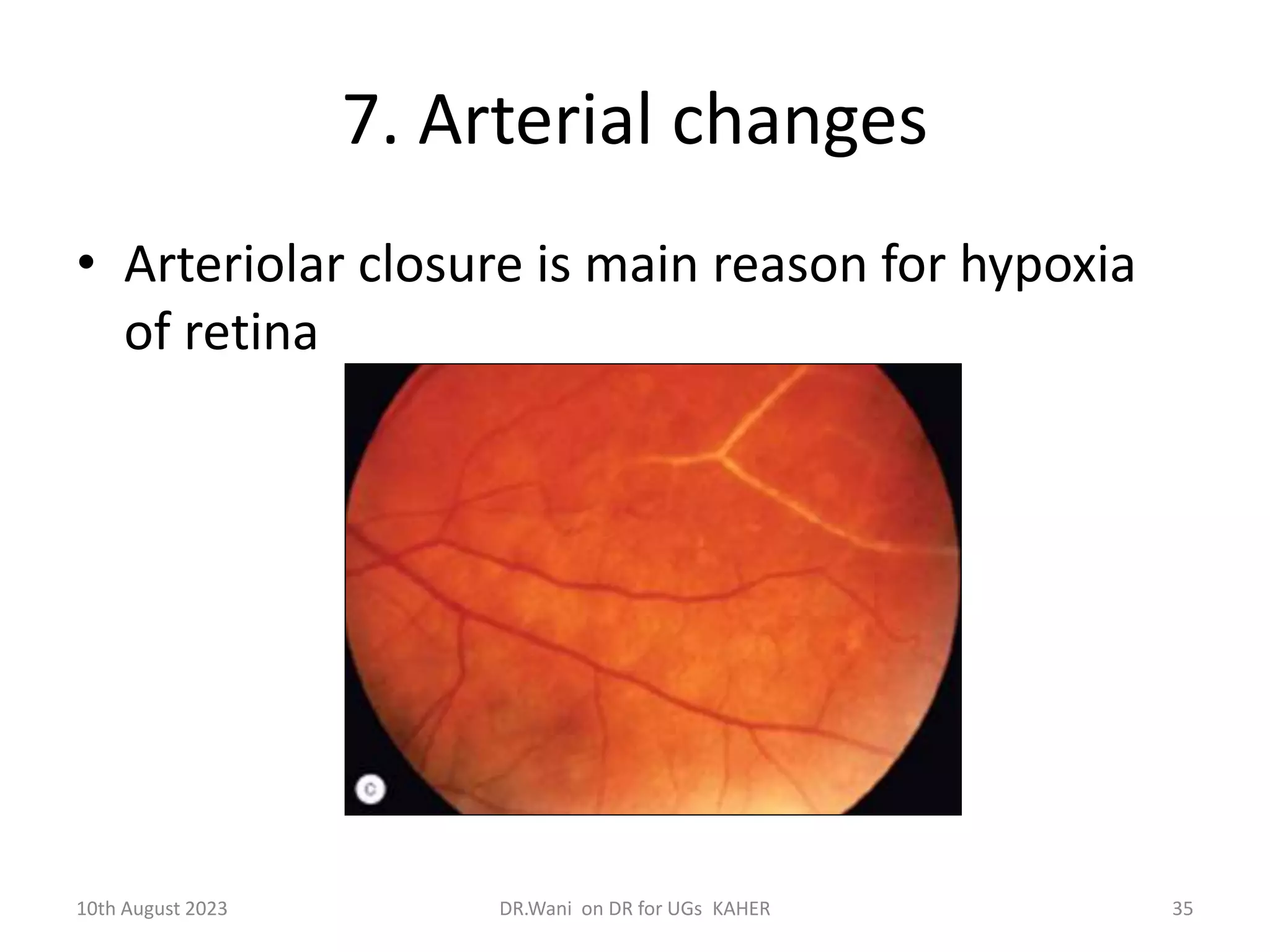 DR VIVEK WANI TALK ON DIABETIC RETINOPATHY FOR KLE MBBS STUDENTS UG ...