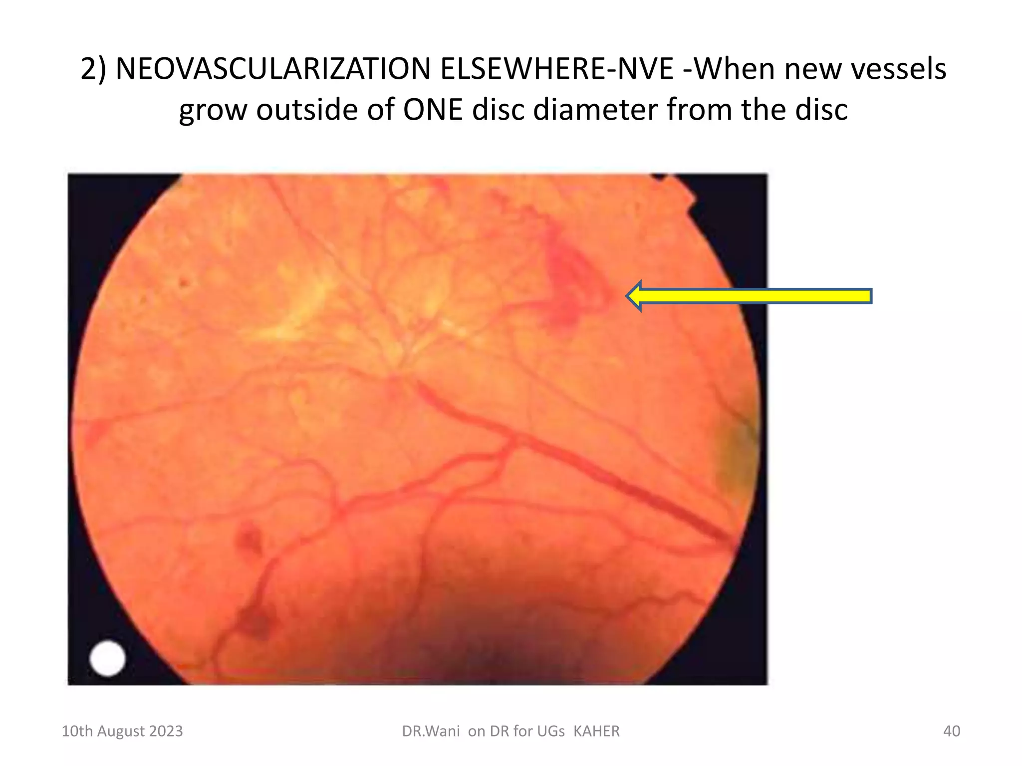 DR VIVEK WANI TALK ON DIABETIC RETINOPATHY FOR KLE MBBS STUDENTS UG ...