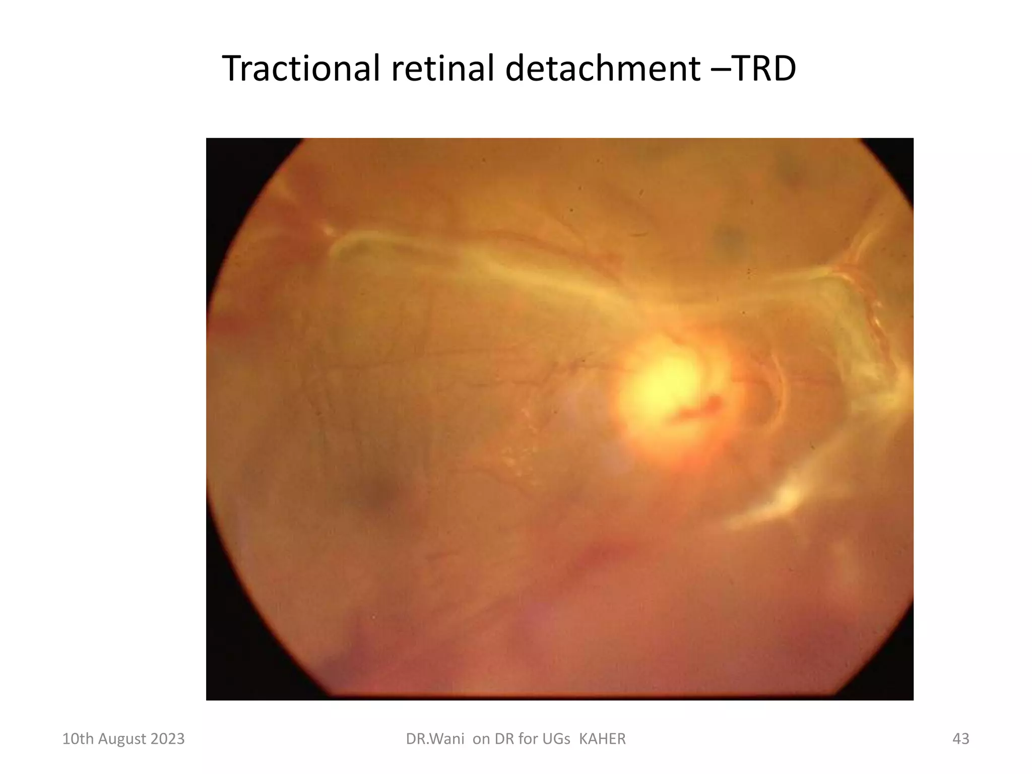 DR VIVEK WANI TALK ON DIABETIC RETINOPATHY FOR KLE MBBS STUDENTS UG ...