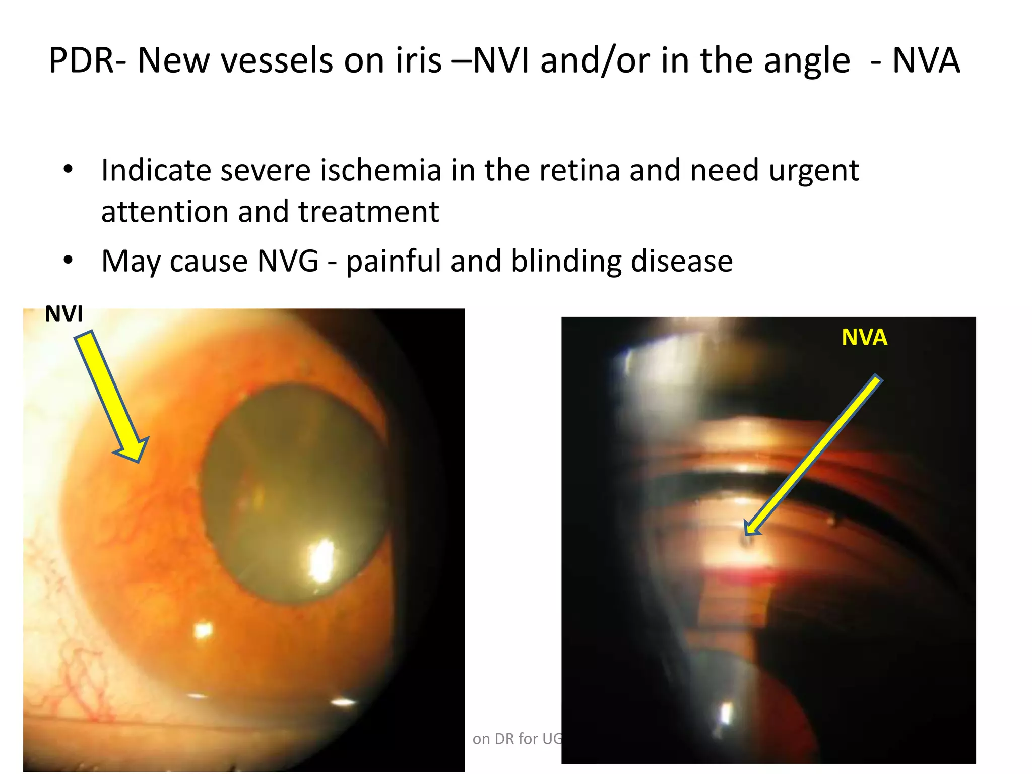 DR VIVEK WANI TALK ON DIABETIC RETINOPATHY FOR KLE MBBS STUDENTS UG ...