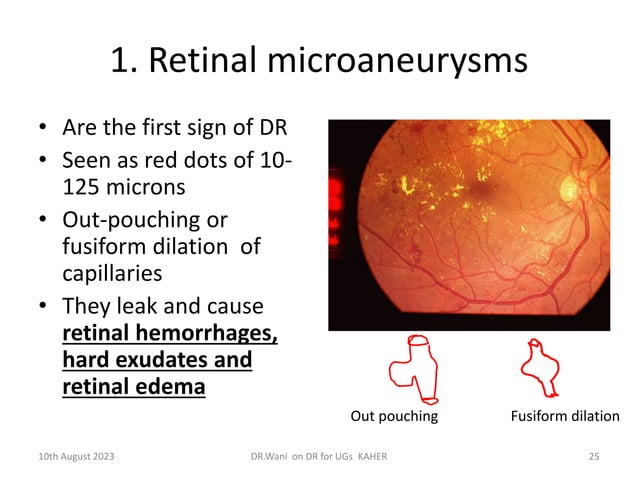 DR VIVEK WANI TALK ON DIABETIC RETINOPATHY FOR KLE MBBS STUDENTS UG ...